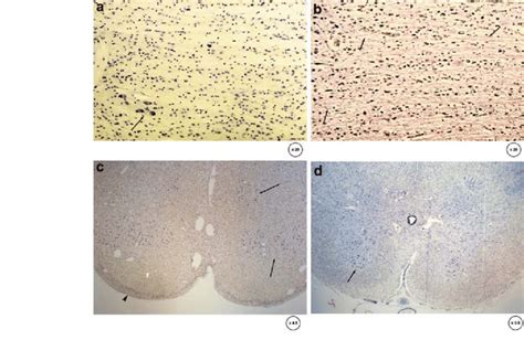 Brain Stem Patient 2 A Pons Basis Pontis Near Absence Of Pontine