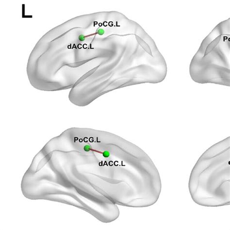 Brain Regions With Group Differences In Global Resting State Functional