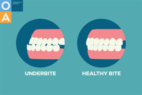 Orthodontics Australia What Causes An Underbite