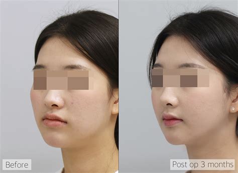 양악수술 광대 사각턱 앞턱
