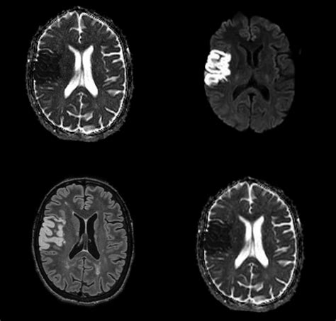 Mri Showing A Brain Infarction In The Right Frontoparietal Region Download Scientific Diagram