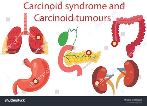 Carcinoid Syndrome Carcinoid Tumoursbowelsappendixstomach Pancreas Lung Stock Vector Royalty