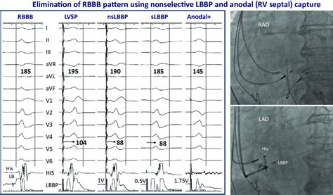 Left Bundle Branch Pacing LBBP In A Patient With Right Bundle Branch Download Scientific