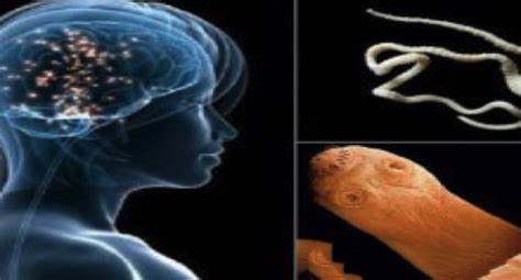 ყველასთვის საყვარელი ეს პროდუქტი ტვინში ჭიების წარმოქმნას განაპირობებს აი რას ამბობენ