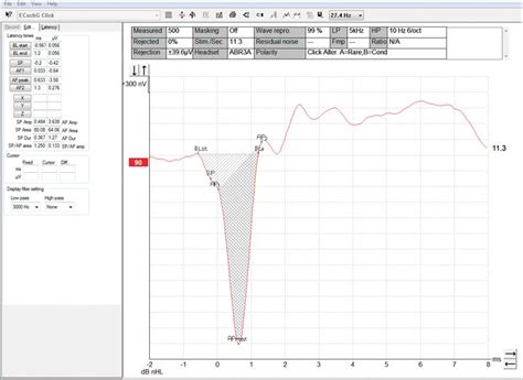 Eclipse Electrocochleography Interacoustics