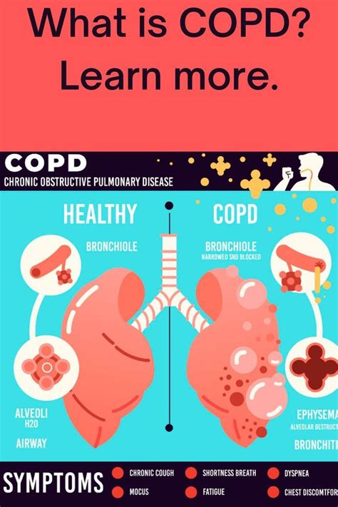 The 4 Copd Gold Stages Explained Artofit