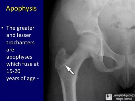 Fracture Mimics Dr Muhammad Bin Zulfiqar