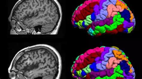 Quantitative Mri For Neurosurgical Risk Assessment Bornupdates