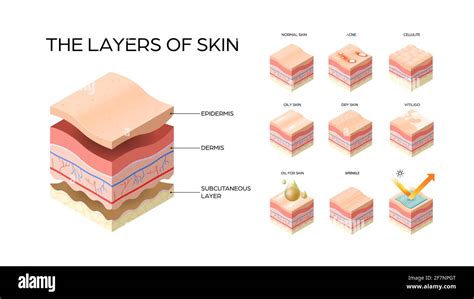 Set Different Types Skin Layers Cross Section Of Human Skin Structure