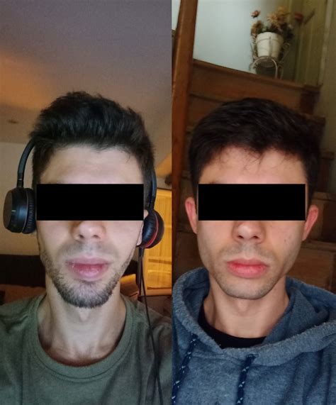 Chewing Gum With Tmj R Mewing