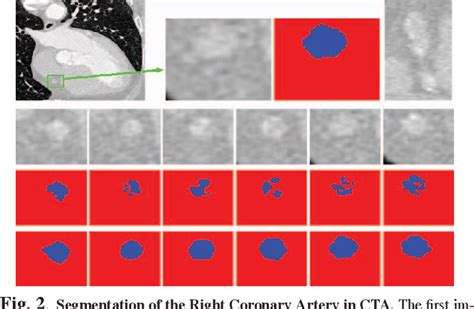 Figure 2 From Vessel Segmentation Using 3d Elastica Regularization