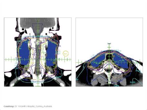 160 Mlc Multileaf Collimator Siemens Healthineers