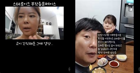 이수근♥ 박지연 스테로이드 부작용으로 얼굴 퉁퉁 투석 후 윤곽 주사 맞기도 시술 고백