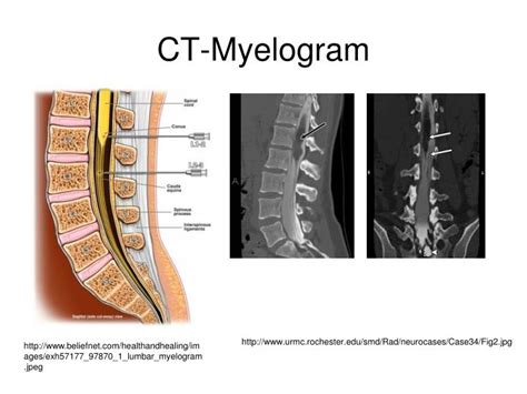 Ppt Spinal Cord Compression Powerpoint Presentation Id 851177
