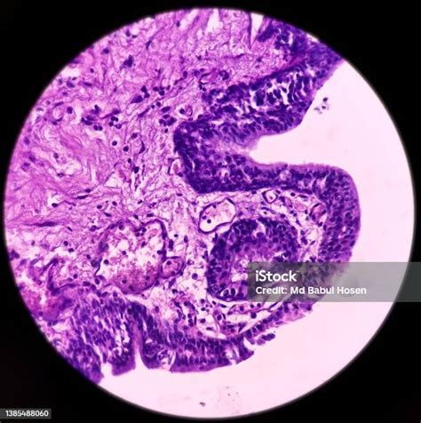 전립선암 선암 악성 신생물 비정형 상피 세포 악성 종양 세로 구도에 대한 스톡 사진 및 기타 이미지 세로 구도 연구 건강 검진 Istock