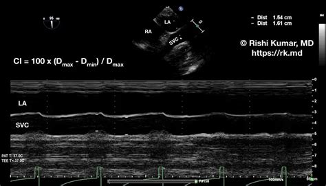 Superior Vena Cava Svc Collapsibility Index Ci Rkmd