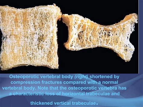Osteoporosis Pathology Lecture 2020 Mbbs Pdf