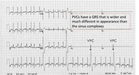 Lecture 20 Ventricular Conduction Delay And Miscellaneous Flashcards Quizlet