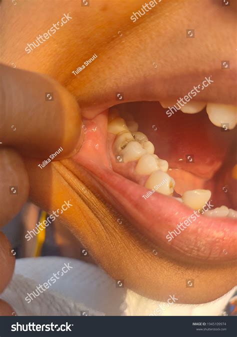 42 Proximal Caries 이미지 스톡 사진 및 벡터 Shutterstock