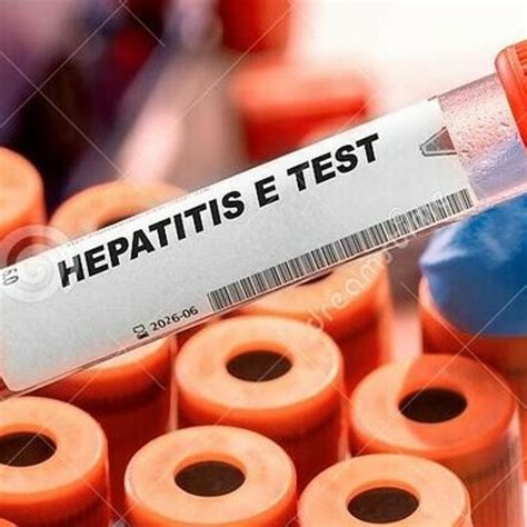Hepatitis E Outbreak Reported In Twic County South Sudan