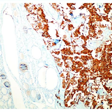 Diffuse Synaptophysin Stain Reaction In Medullary Carcinoma Tumor Cells