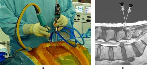 Biportal Endoscopic Versus Microscopic Discectomy For Lumbar Herniated
