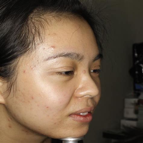 Acnedetection Object Detection Dataset By Acnedetection