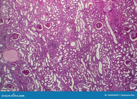 Chronic Pyelonephritis Light Micrograph Stock Image Image Of Tissue Disease 164443699