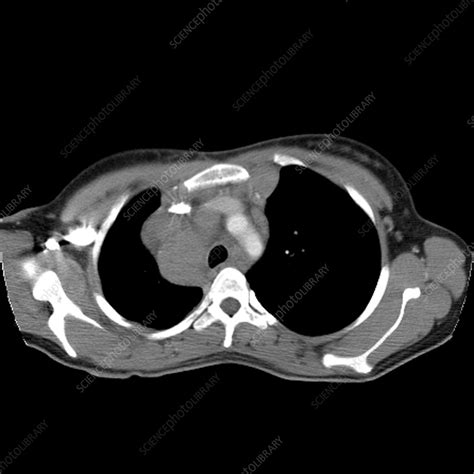 Lung Cancer Ct Scan Stock Image C0584496 Science Photo Library