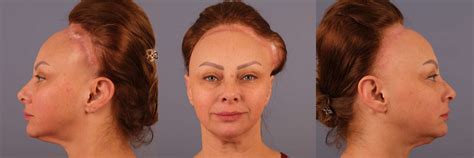 Forehead Reduction In Turkey Dr Cengizhan Ekizceli
