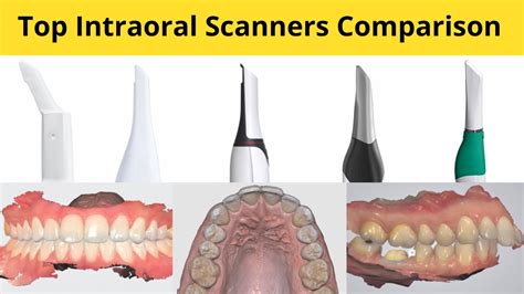 Intraoral Scanner Comparison At Timothy Gordon Blog