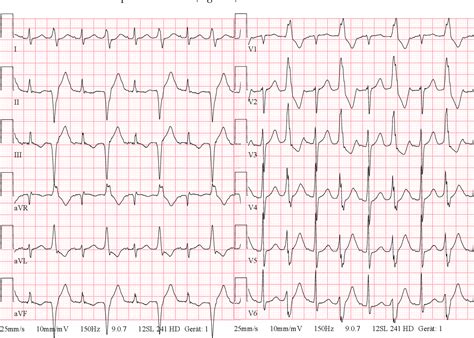 Figure 1 From Fusion Imaging Of Non Invasive And Invasive Cardiac