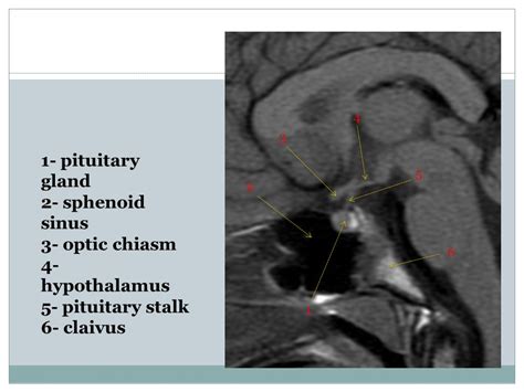 Pituitary Gland Anatomy Mri