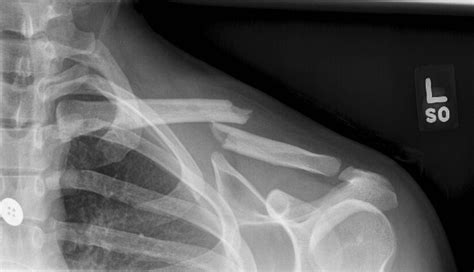 Fracture Displacement And Shortening Download Scientific Diagram