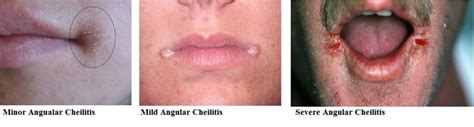 What Is Angular Cheilitis Symptoms Types Causes Chronic Treatments