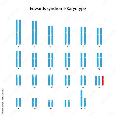 Edwards Syndrome Trisomy 18 Human Male Karyotype Stock Illustration