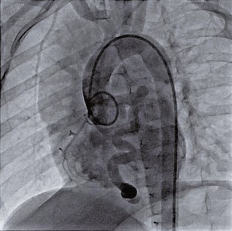 Transcatheter Closure Of Coronary Artery Fistula With Amplatzer Piccolo™ Device Journal Of