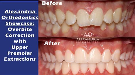 Overbite Correction Before And After Pictures Can Invisalign Fix