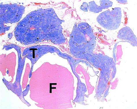 Idiopathic Multilocular Thymic Cyst Ct Features With Clinical And