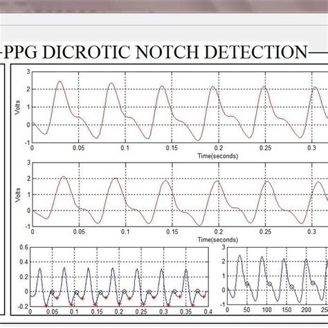 Pdf Novel Notch Detection Algorithm For Detection Of Dicrotic Notch In Ppg Signals