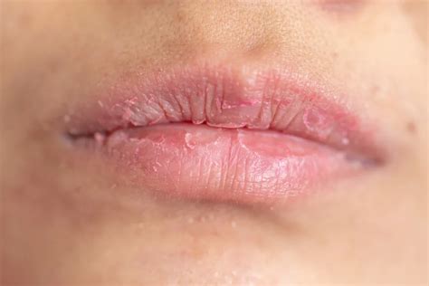 Best Lips Rejuvenation Clinic In Malaysia Nextmed Clinic