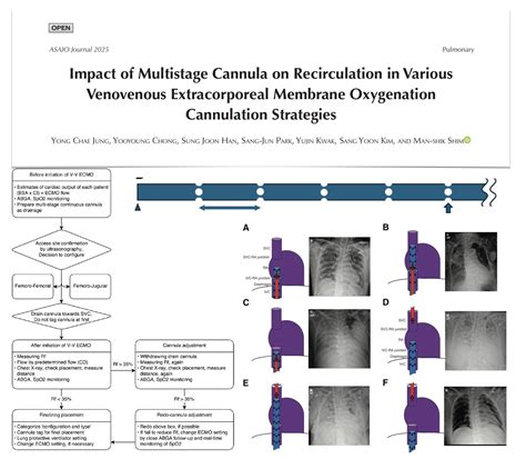 Elso Extracorporeal Life Support Organization Recirculation In Veno Venous Ecmo According