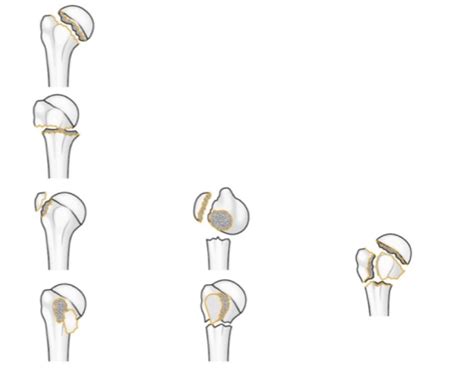 Neer Classification Of Humeral Fractures Quiz