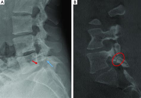 Visualisation Of The Fracture Line At The Level Of The Pars Download Scientific Diagram