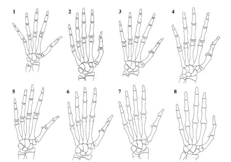 What Is The Sanders Maturity Scale For Bone Age Growing Spine Blog