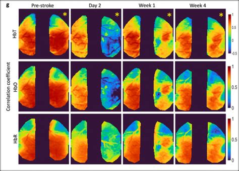 Insights Into Neurovascular Coupling Hold Promise For Post Stroke Monitoring And Recovery