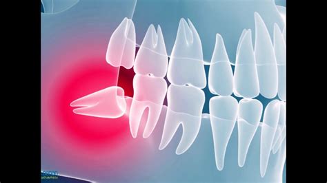 სიბრძნის კბილი რა პრობლემები ახლავს და როდისაა საჭირო მისი ექსტრაქცია Youtube