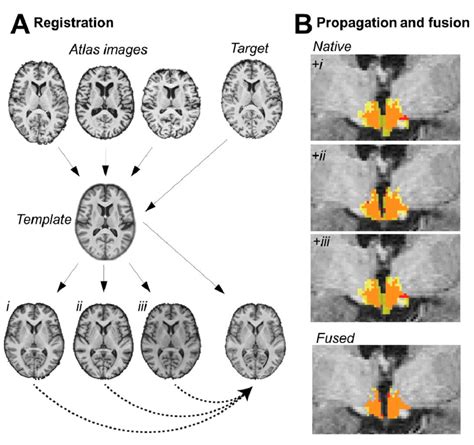 Multi Atlas Fusion Segmentation For Automated Hypothalamus Download Scientific Diagram