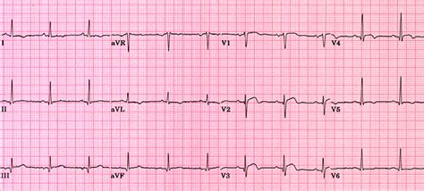 Myocardial Infarction Ecg Interpretation