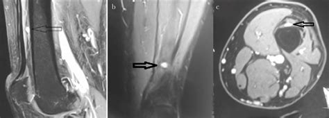 A C Post Contrast Fat Saturated T1 Weighted Mri Images Showing An